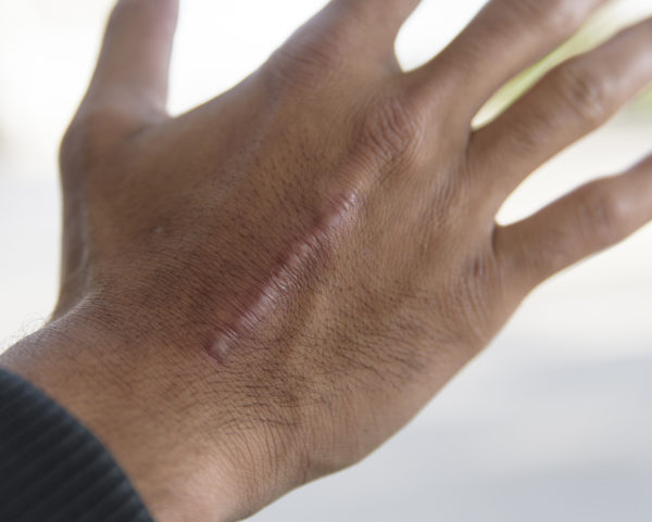 Compounding Medications for Wound and Scar Therapy | Help with Scarring